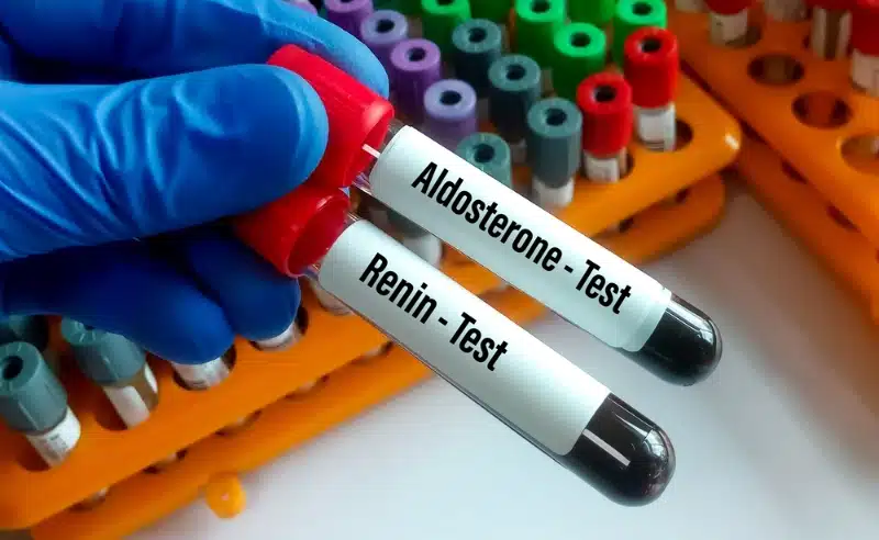 اختبار الرينين والألدوستيرون (Aldosterone and Renin Test) | موقع طبيب